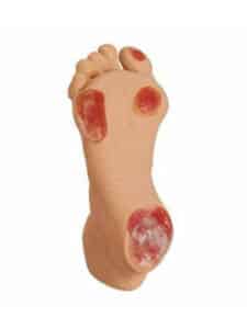 Get Treated With Advanced Wound Care for Feet & Ankle