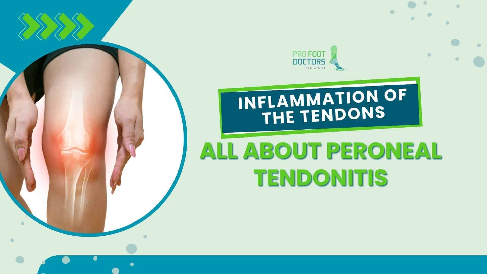 Inflammation Of The Tendons: All About Peroneal Tendonitis