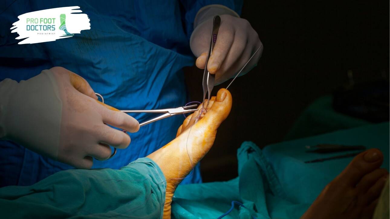 The Role of Debridement in Diabetic Foot Wound Healing?