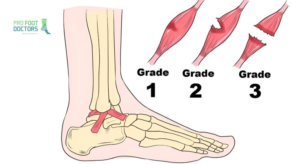 Rolled Ankle? How Do You Know It is Serious and Needs Help?