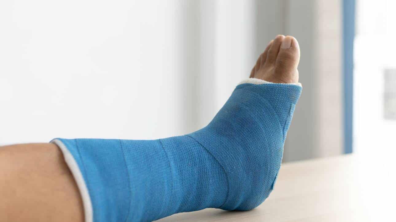 Foot Fractures - Pro Foot Doctors