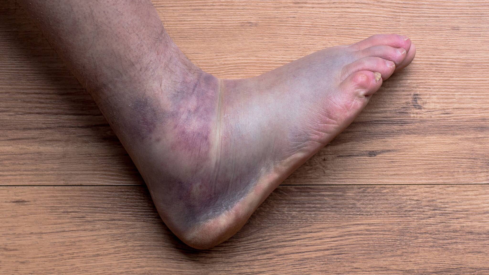 Foot Fractures - Pro Foot Doctors