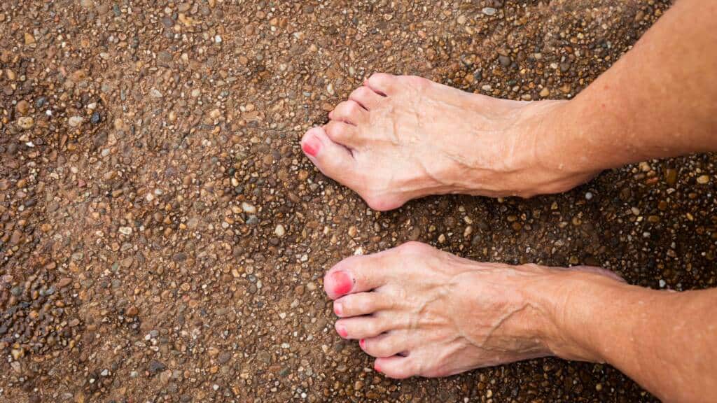 Hammertoe - Pro Foot Doctors