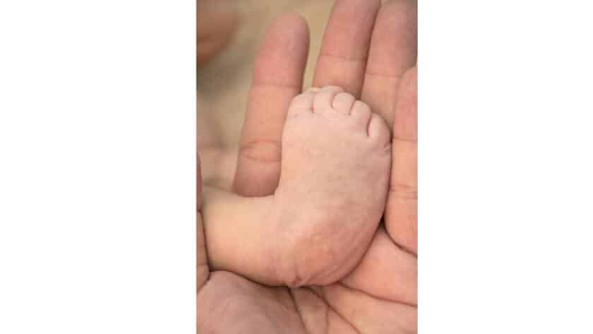 Pediatric Deformities - Pro Foot Doctors