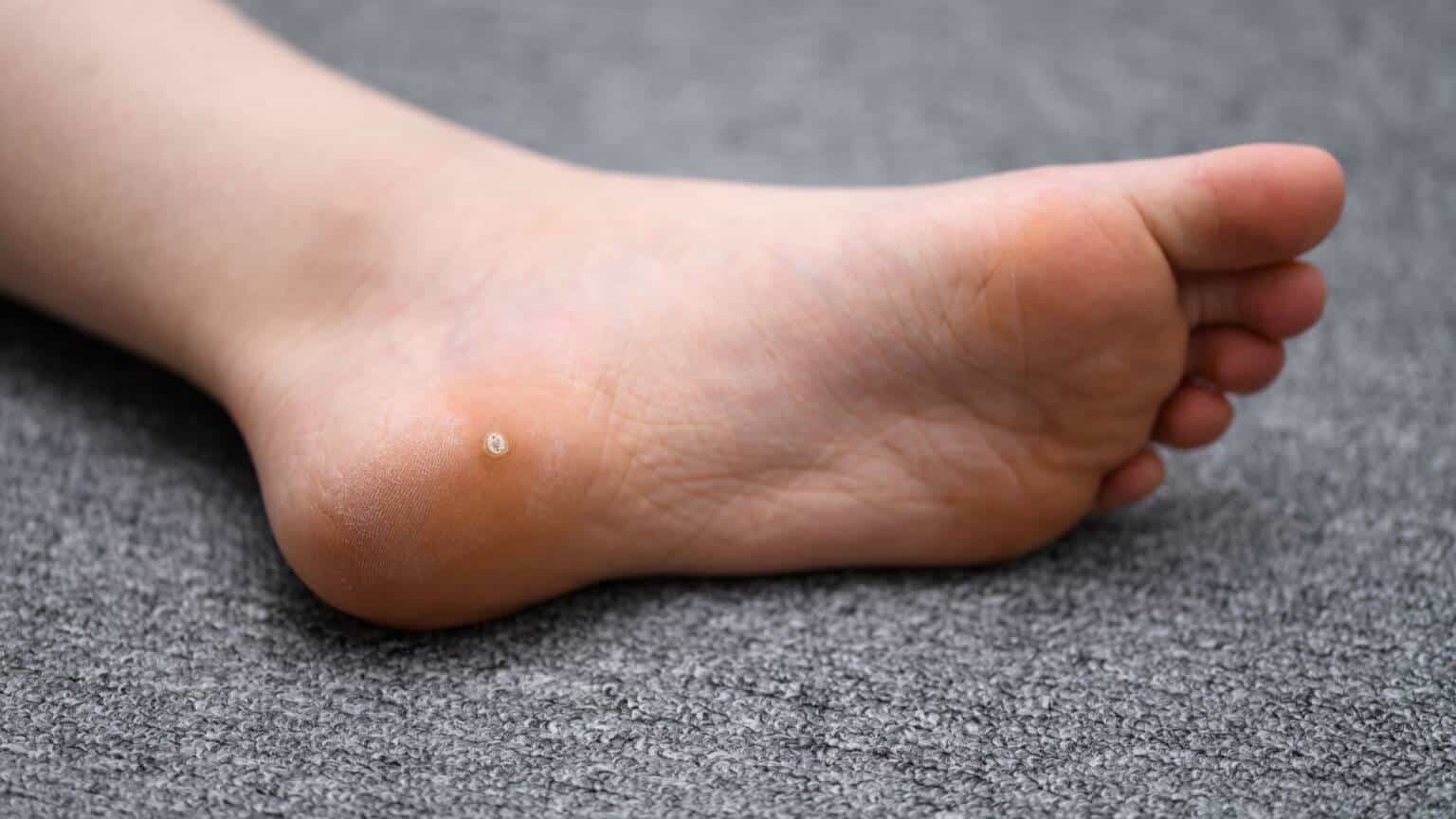 Warts - Pro Foot Doctors
