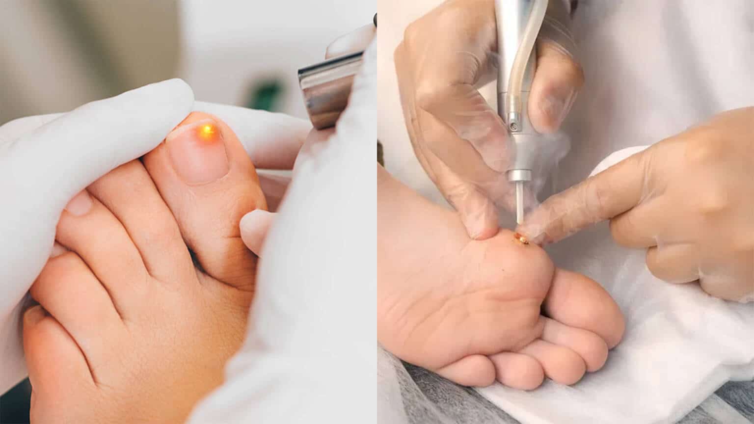 Laser Therapy for Foot - Pro Foot Doctors