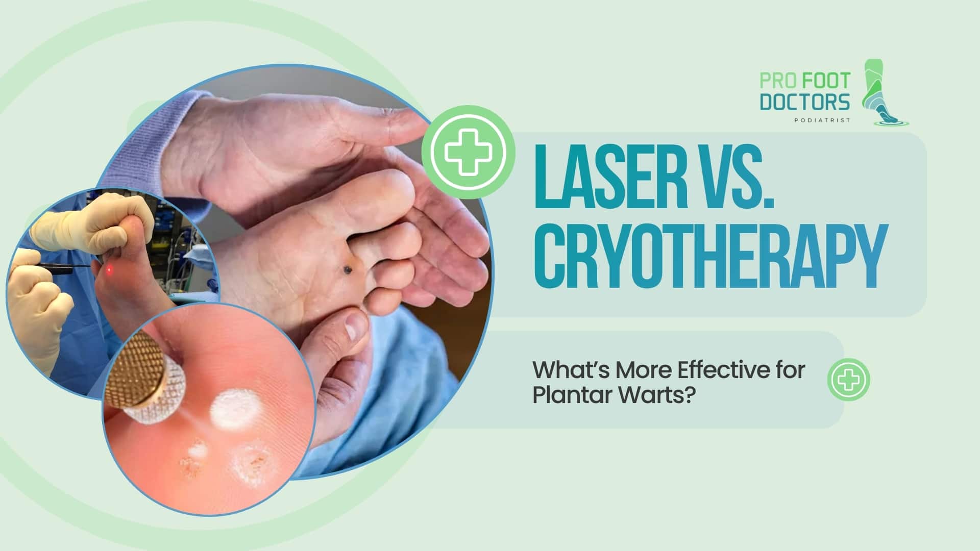Laser vs. Cryotherapy Whats More Effective for Plantar Warts