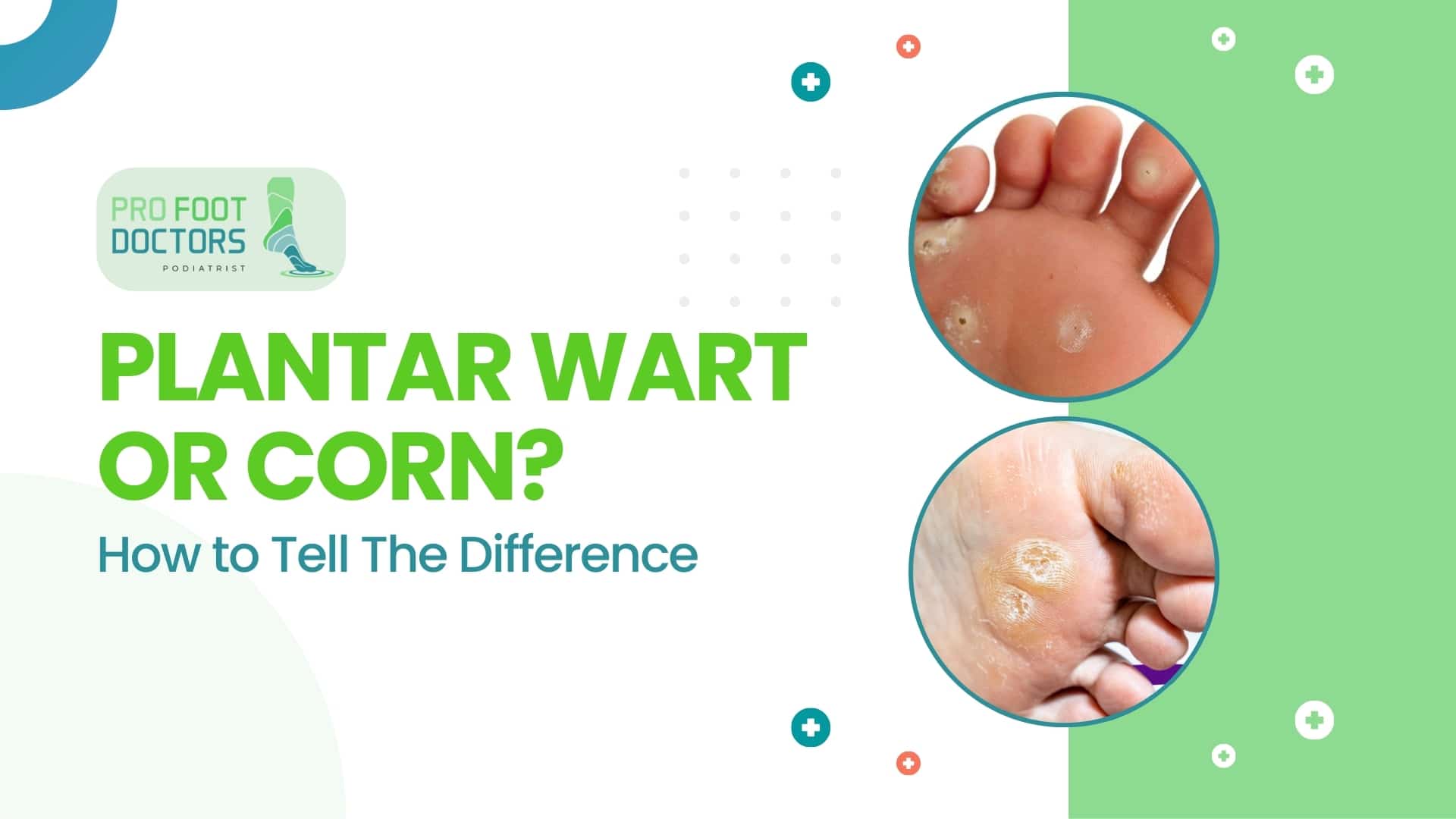 Plantar Wart or Corn? How to Tell the Difference